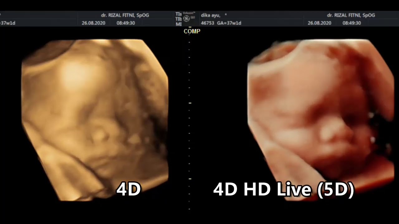 Perbedaan tampilan usg 4D dengan 5D / 4D HD Live - YouTube