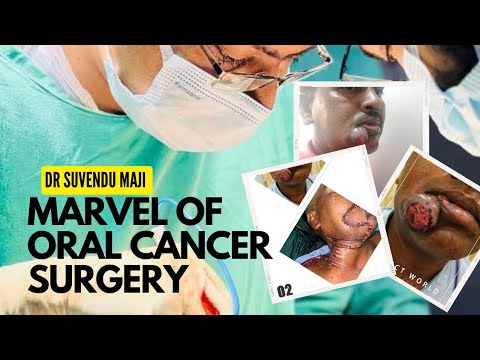 Results of surgery for advanced oral cancer. - YouTube