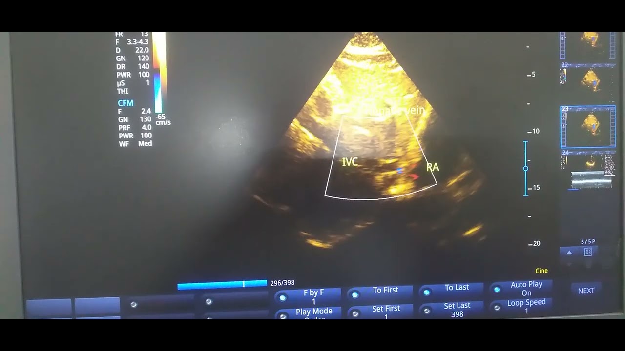 Subcostal view showing IVC, with normal dimension and inspiratory ...