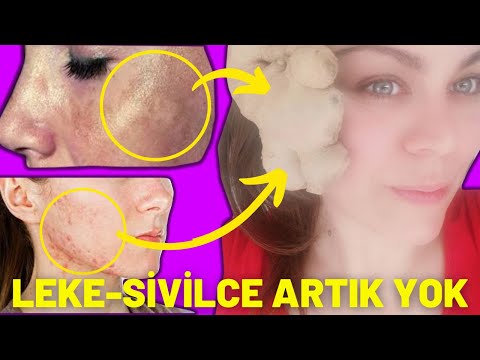 15 DAKİKADA SİVİLCE VE CİLT LEKELERİNİ SİLİP ATAN ZENCEFİL-ZERDEÇAL MASKESİ! DOĞAL CİLT BAKIMI