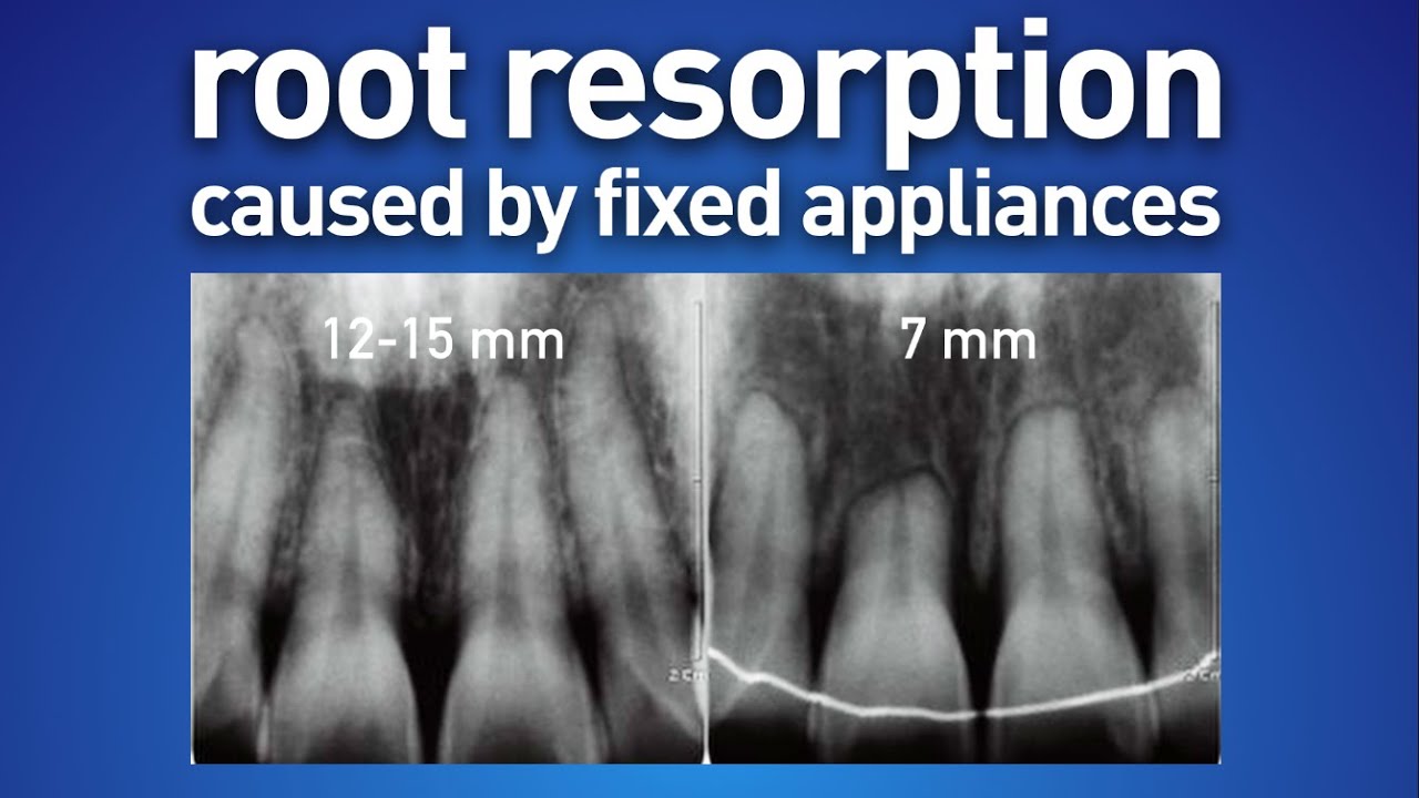 Root resorption caused by fixed appliances - YouTube