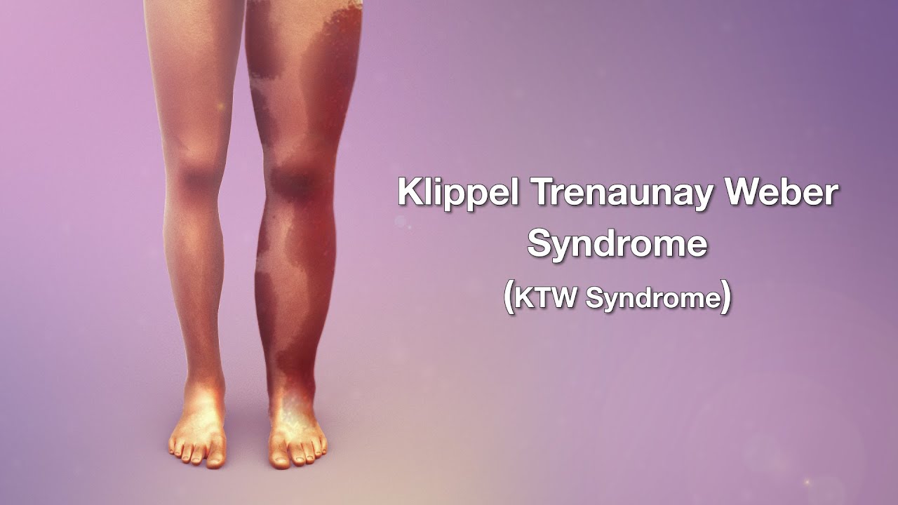 Klippel Trenaunay Syndrome (Weber) ; Characteristics, Symptoms, Causes ...