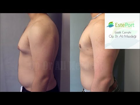 Ameliyatsız Erkek Memesi Küçültme