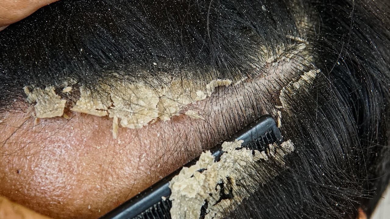 Satisfying Dandruff Cleaning, Hand & Brush for Ultimate Relaxation # ...