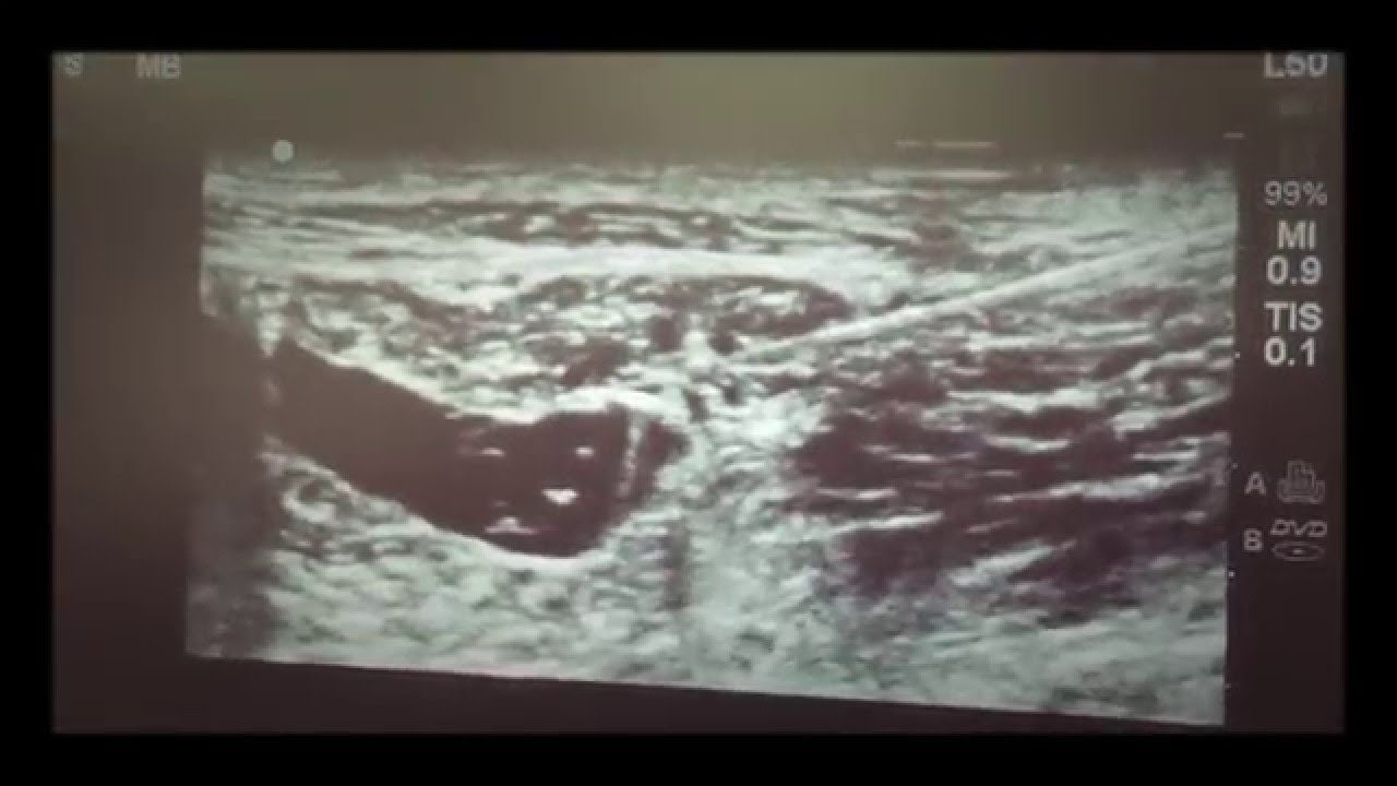 Quadratus Lumborum Ql3 Block Usg Guided Youtube