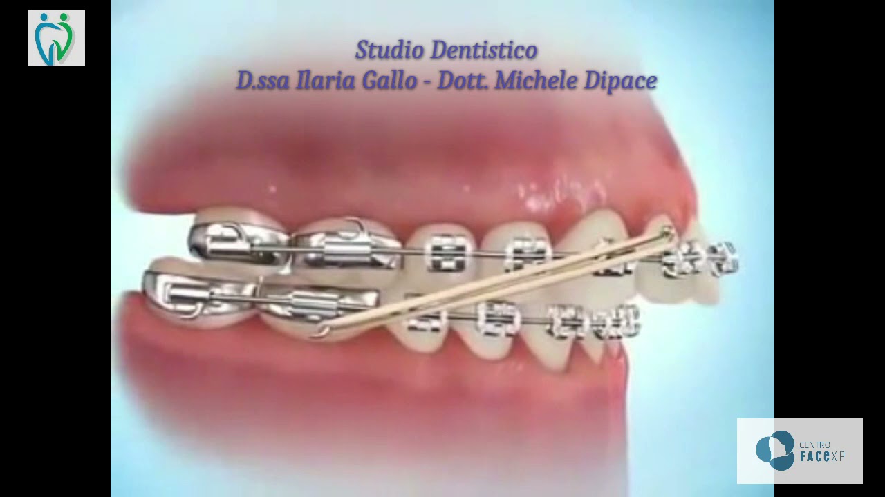 Elastici - Malocclusione II Classe - YouTube