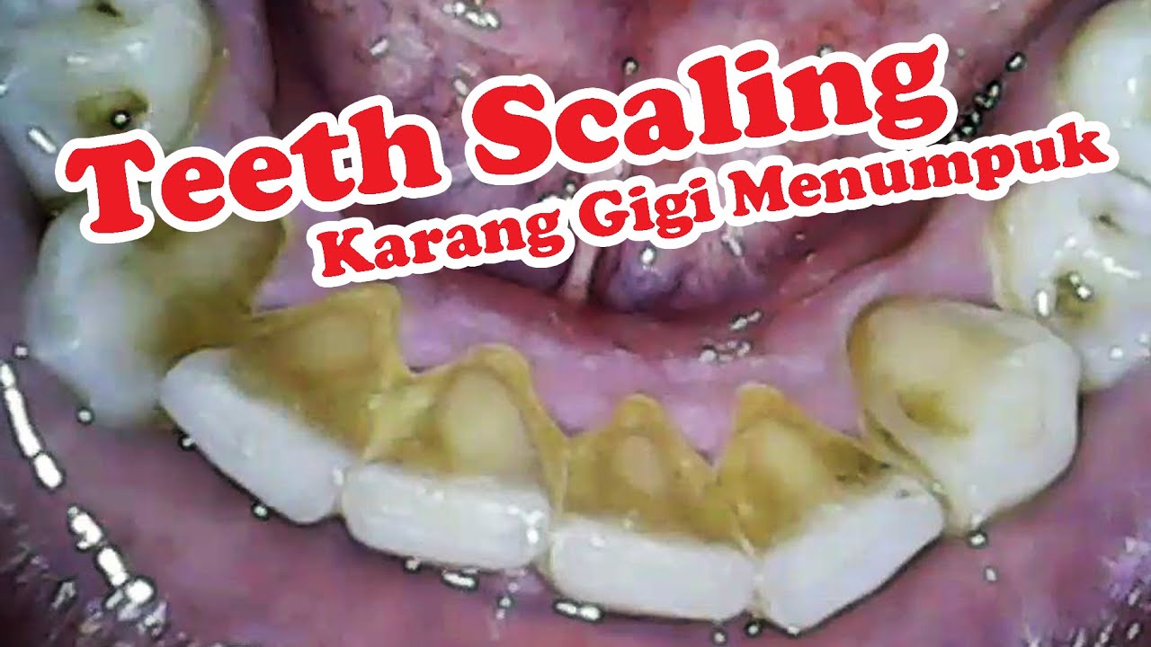Bikin Ngilu!! Scaling | Pembersihan Karang Gigi | Tartar Removal - YouTube
