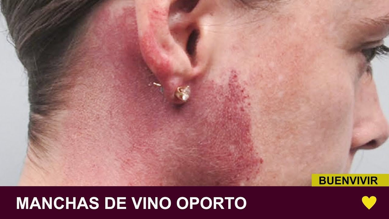 MANCHAS DE VINO OPORTO - MONTEVIDEO SKIN - BUENVIVIR💛 26/06/23 Canal 4 ...