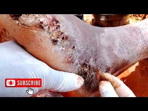 EXTREME JIGGER REMOVAL.DONT WATCH. - YouTube