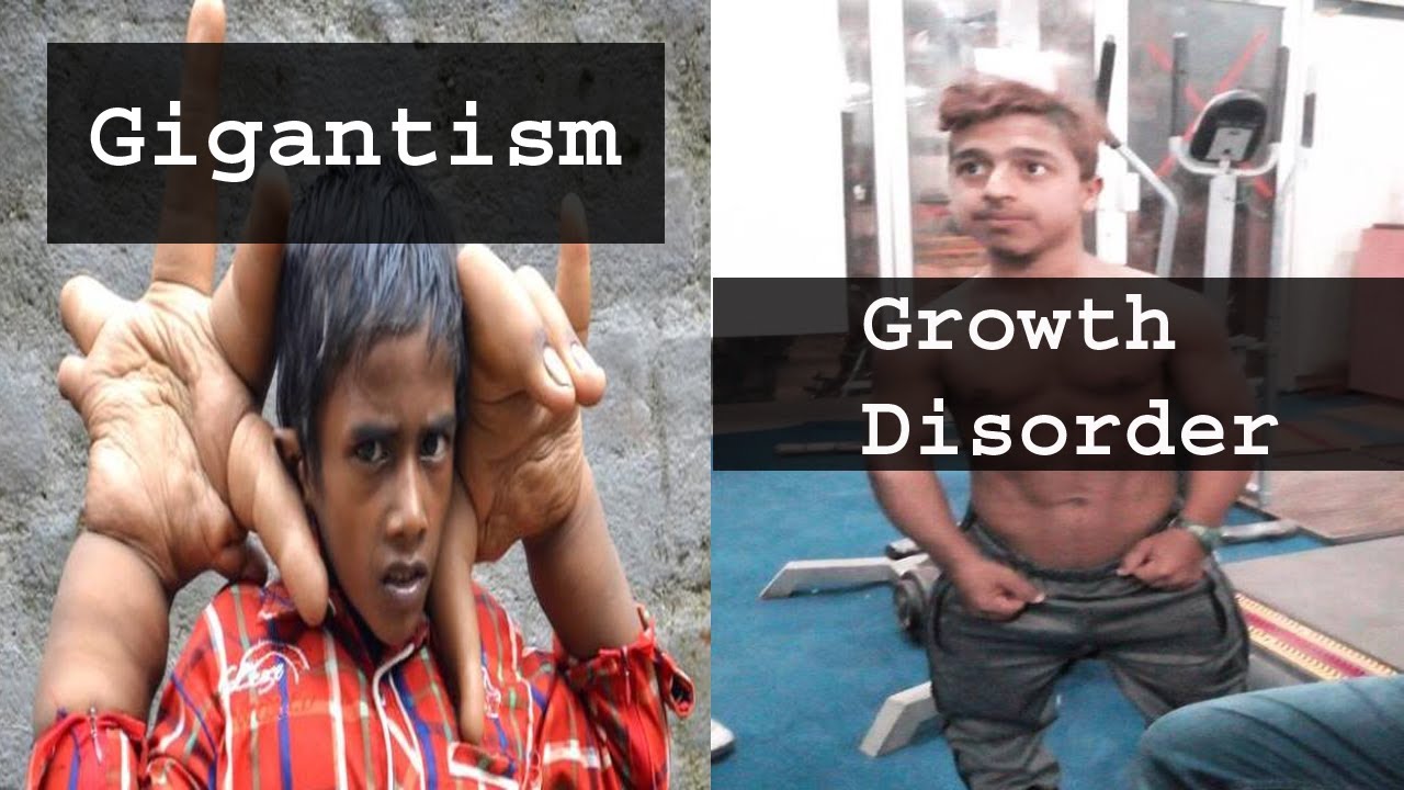 Growth hormone deficiency | Pituitary gland tumor symptoms | What is ...