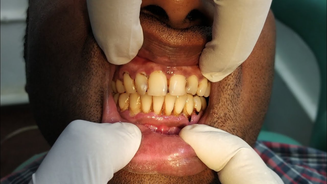 OSMF - INITIAL SIGNS AND SYMPTOMS - YouTube