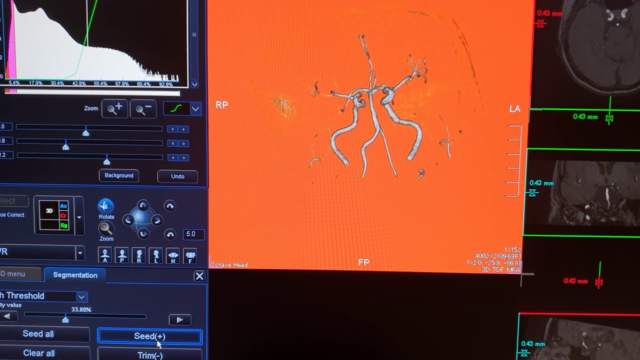 Brain angio color adjust - YouTube