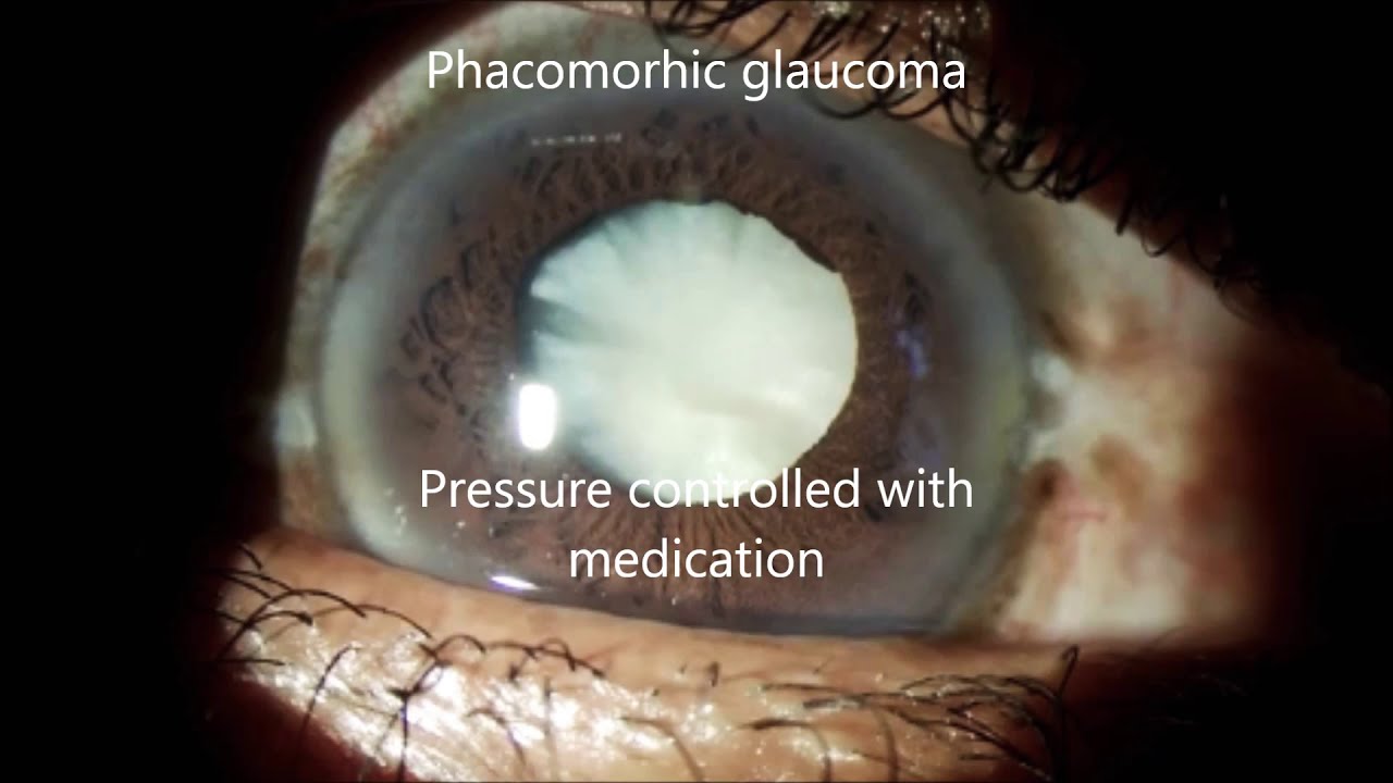 Phacomorphic glaucoma - YouTube