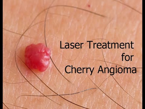 Cherry Angioma Laser Removal - YouTube