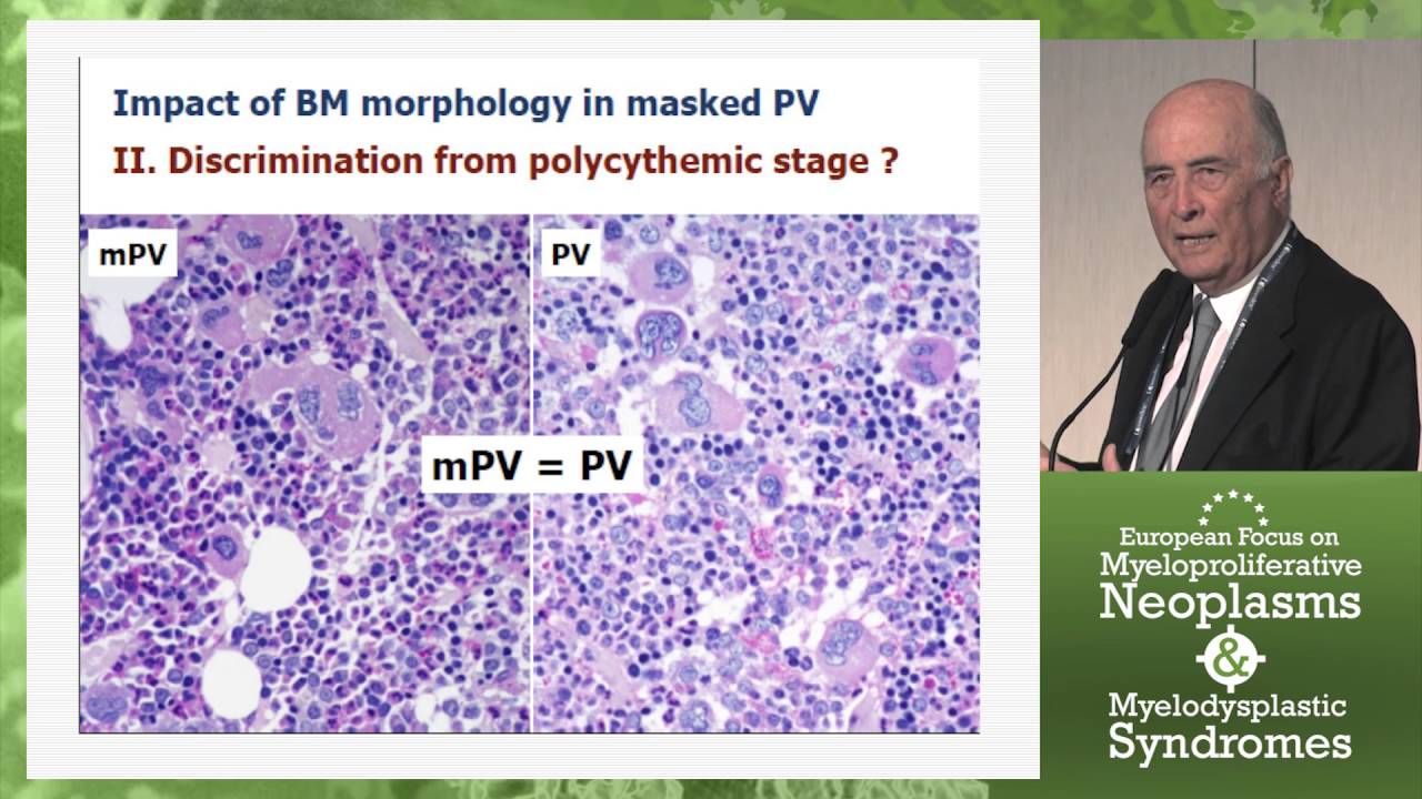 The WHO Updated Diagnostic Criteria for MPN - YouTube