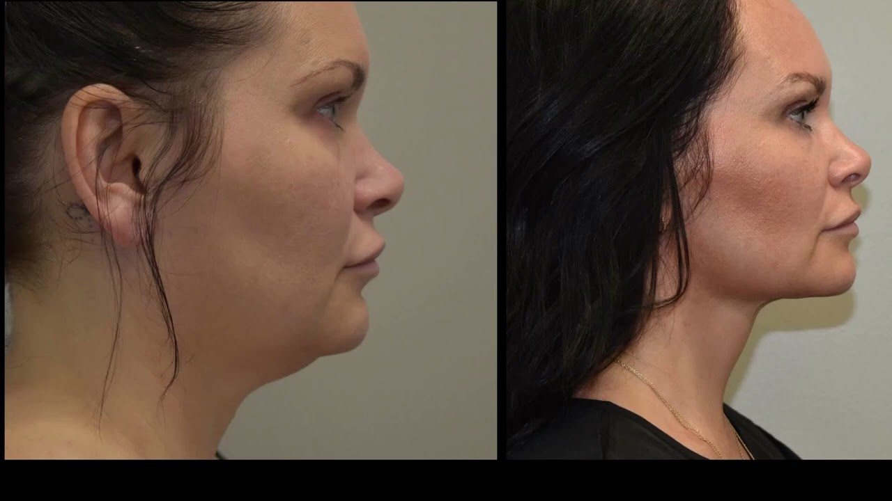 Non-Surgical Neck Lift with a PDO Thread Lift and Botox - YouTube