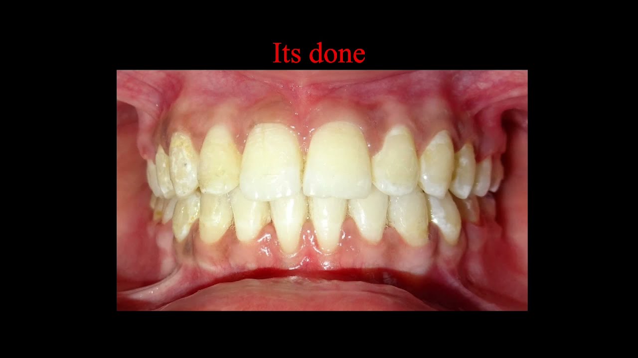 Proclined Teeth - YouTube