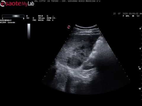 Contusione Epatica - YouTube