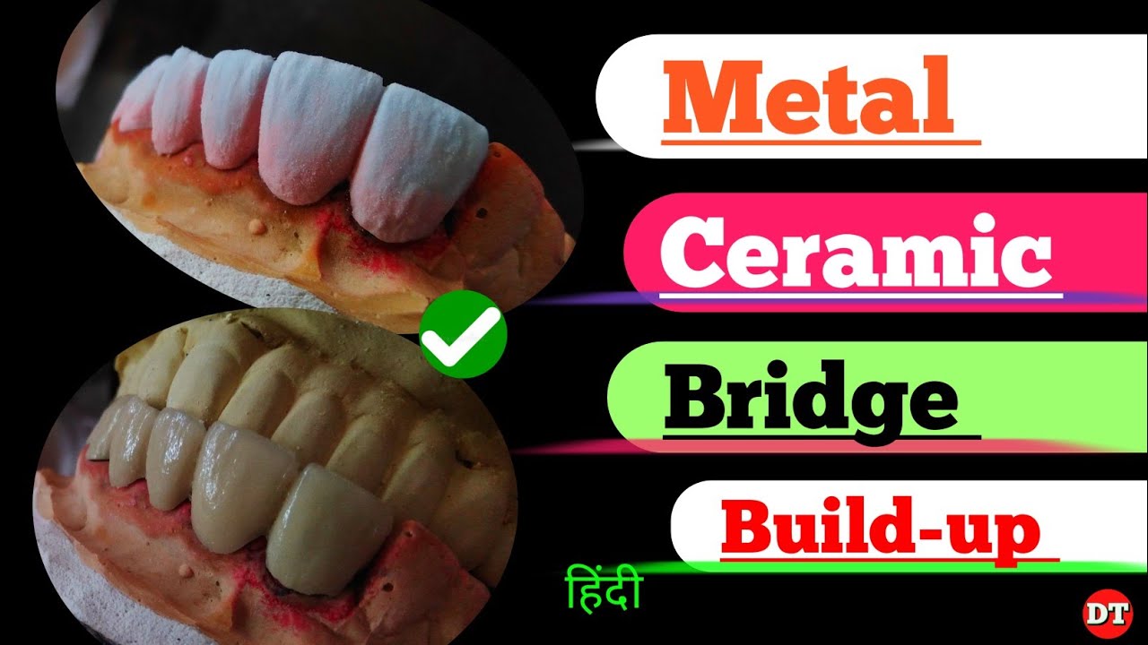 Metal Ceramic Bridge Build up| How to porcelain| Anatomy| Human Tooth ...