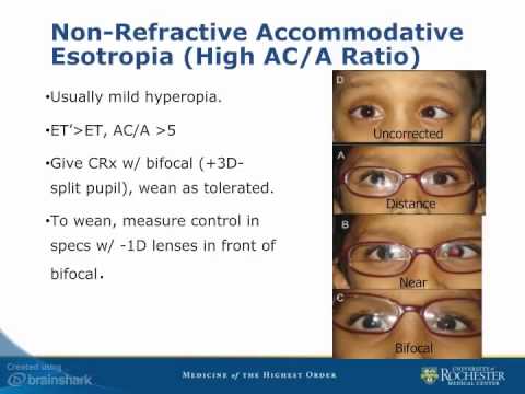 Esotropia - YouTube