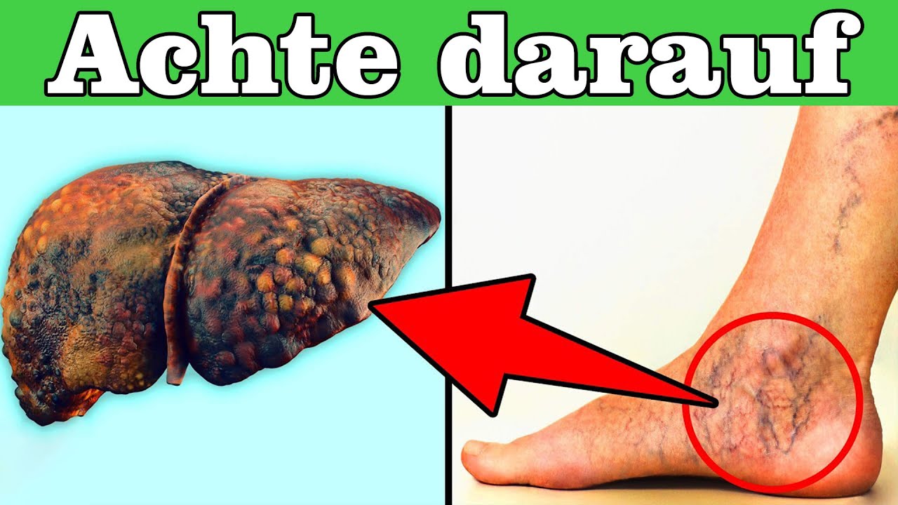 5 Anzeichen dafür, dass deine Füße dir sagen, dass deine Leber PROBLEME ...