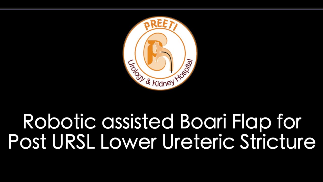 Robotic assisted Boari Flap for Post URSL Lower Ureteric Stricture ...