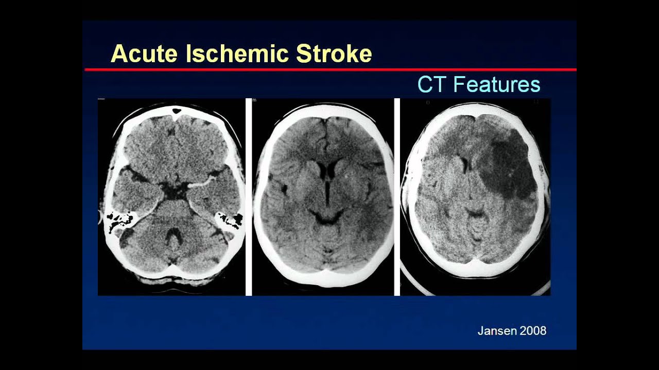 IMAGING ACUTE STROKE YouTube