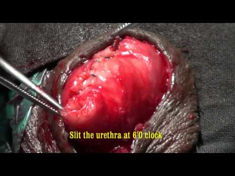 Partial penectomy