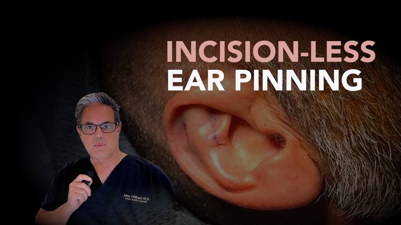 Incision-Less Ear Pinning Explained - YouTube