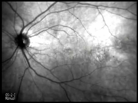 Mouches-Volantes im Auge mit OCT sehr gut erkennbar! - YouTube