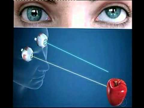 What is a Squint and how to treat it - YouTube