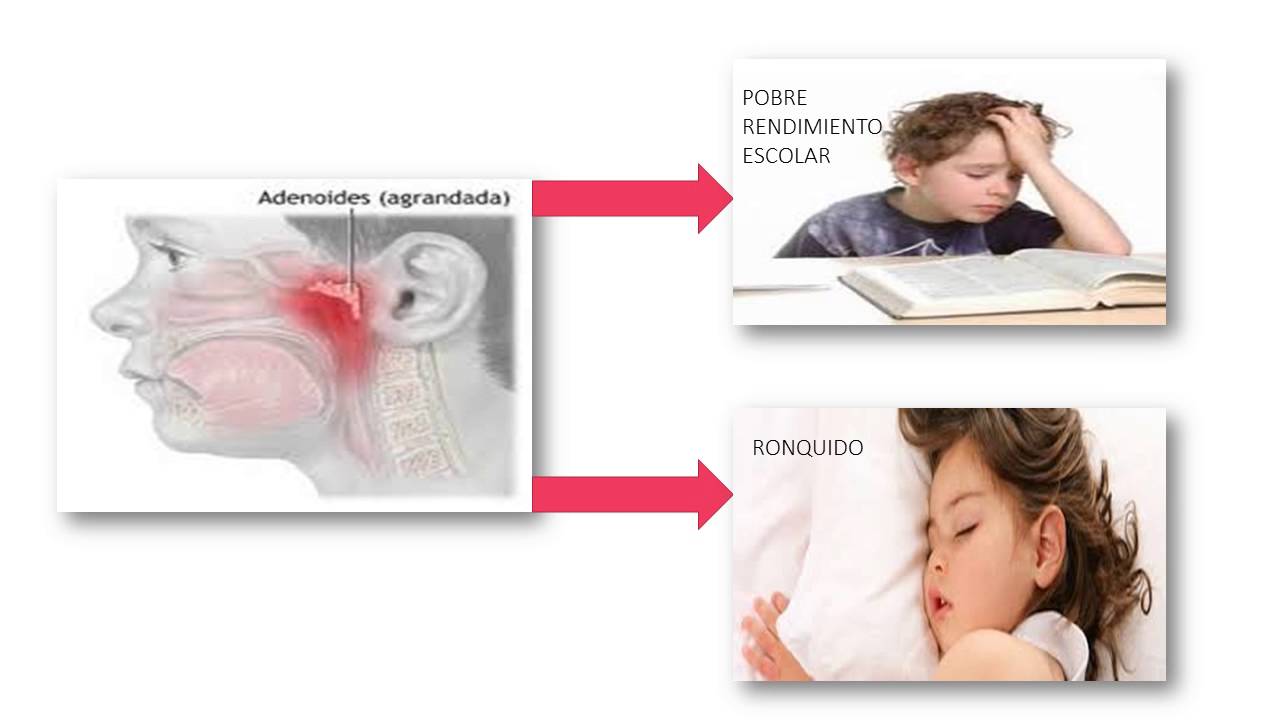 LAS ADENOIDES - YouTube