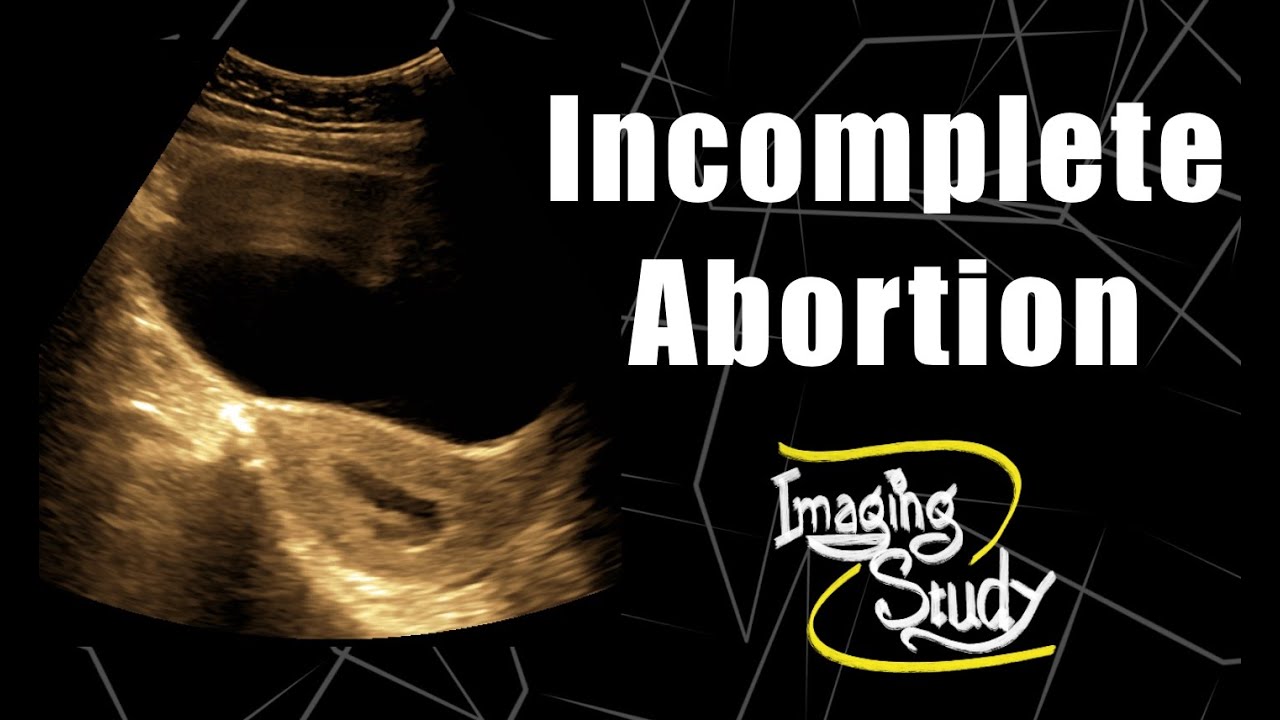 Incomplete Abortion || Ultrasound || Case 84 - YouTube