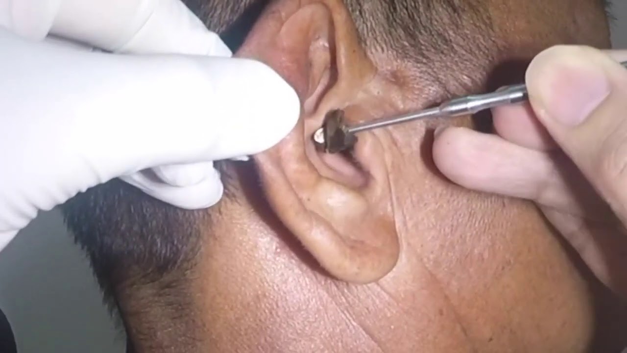 Removing Something Black Lodged In Man's Ear- What Is It Really? - YouTube