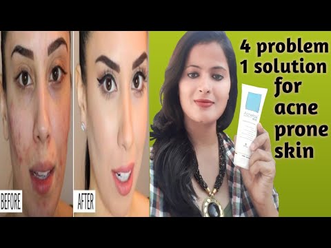 Acnelak 4 in 1 pimple care face wash ( MENARINI ) review / Acnelak face ...