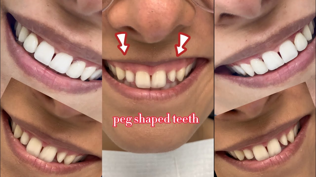 Peg Shaped teeth - YouTube
