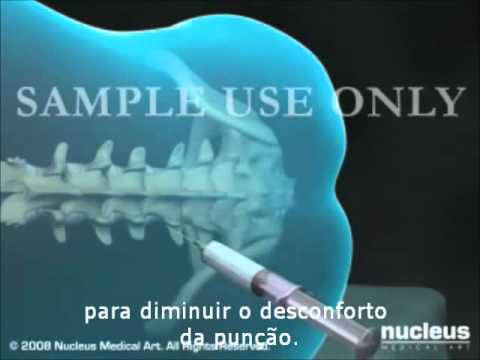 Raquianestesia e anestesia peridural - YouTube