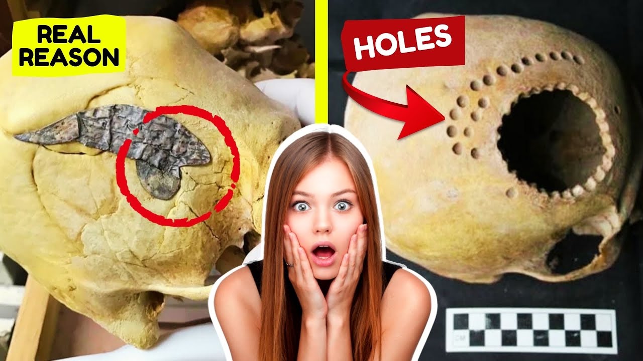 History of Neurosurgery Trepanning - Trepanation / Trephination ...