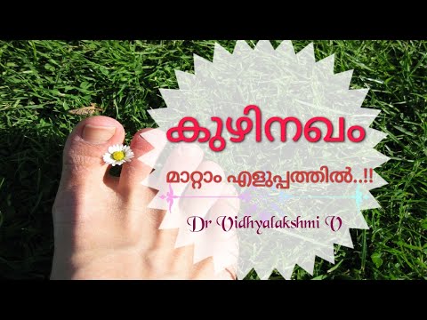 Kuzhinakham | Home Remedy Malayalam|കുഴിനഖം മാറാൻ എളുപ്പവഴി | Dr ...