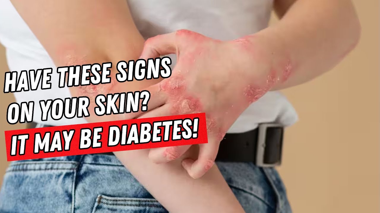 12 Diabetic Skin Problems & Top Signs of Diabetes on The Skin! - YouTube