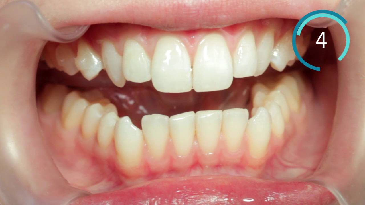 Attachment Replacement Invisalign v06 - YouTube