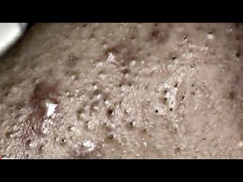 cystic acne treatment, big acne removal compilation - YouTube