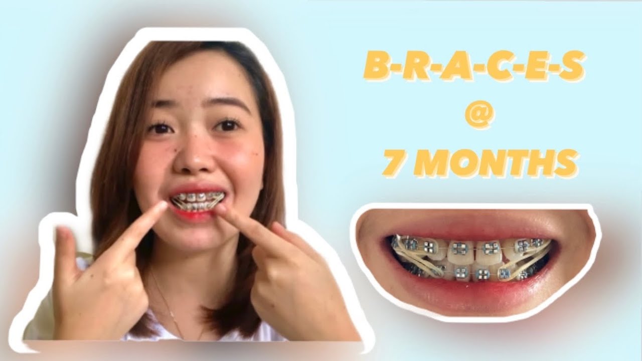 Braces Underbite @ 7 Months l PH - YouTube