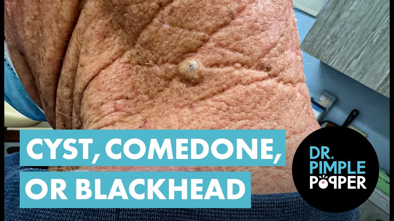 Cyst, Comedone, or Blackhead? What is ON HIS NECK? - YouTube