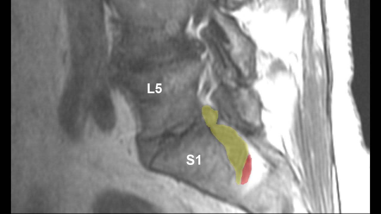 Huge L5 Disc Extrusion Enters Anterior Sacral Foramen! Regional Anatomy ...