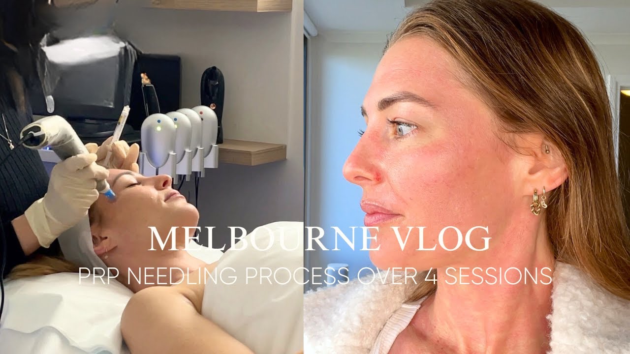 My PRP microneedling experience | Unboxing new YouTube lighting ...