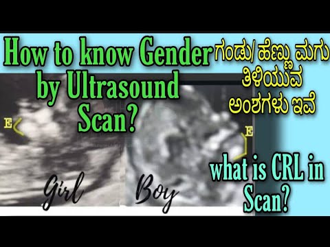 ULTRASOUND SCAN GENDER PREDICTION|CRL ಎಷ್ಟಿದ್ದರೆ ಗಂಡು ಮಗು?How to Know ...