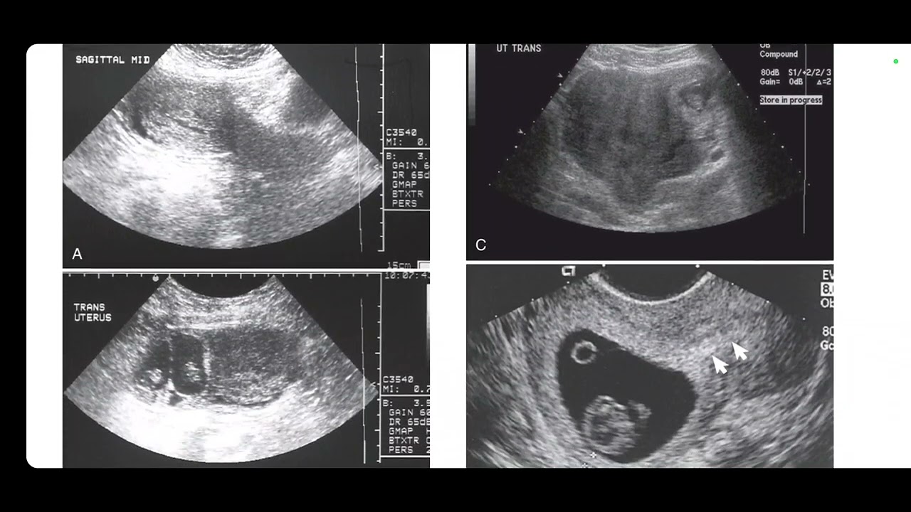 GYNAE / OBS CASE REVIEW SERIES(2) - YouTube
