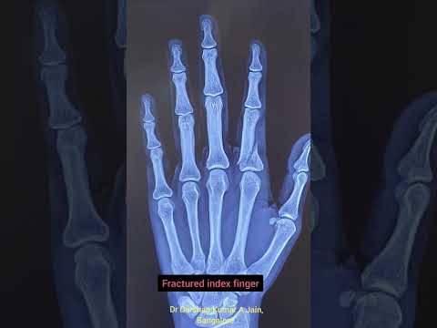 Finger fracture treatment with K wires - YouTube