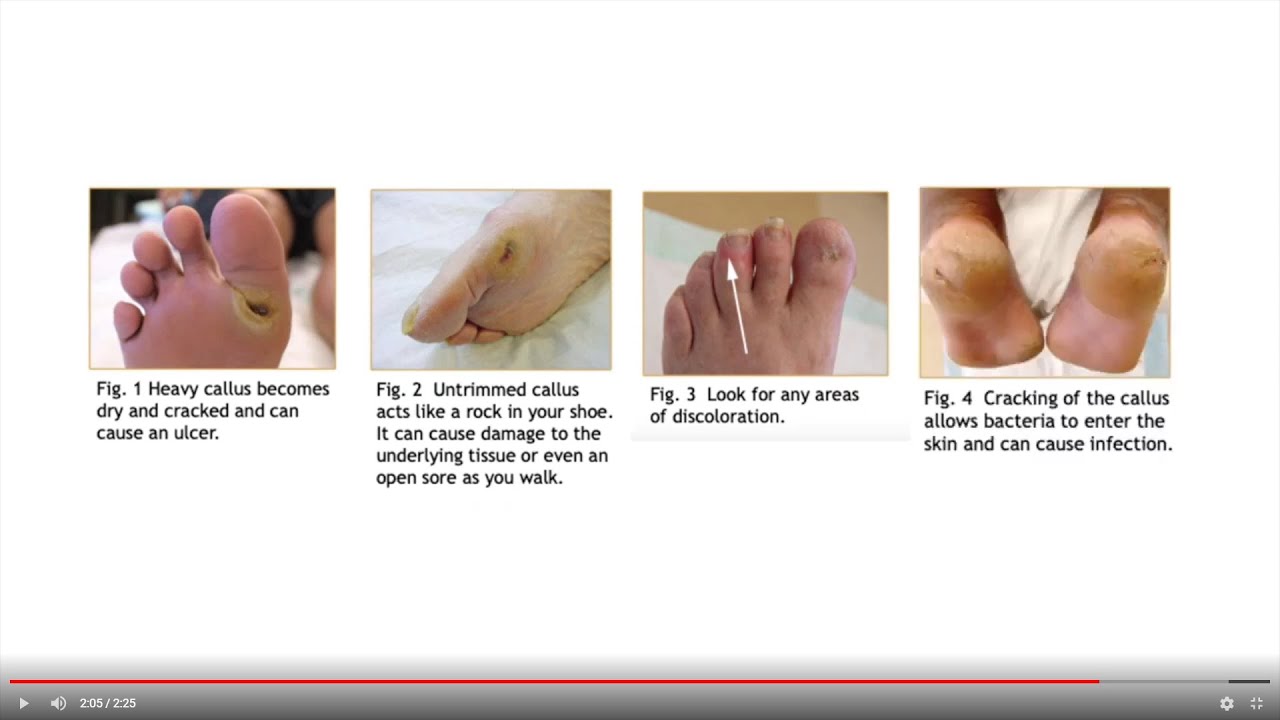 Diabetic Foot Checks - YouTube